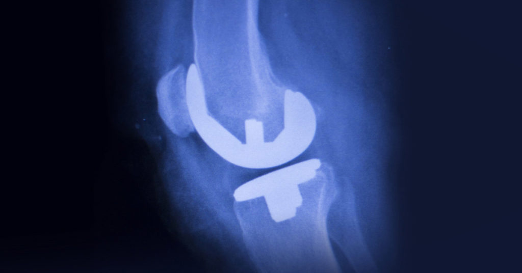 Exactech Knee Recall - Consumer Safety Watch